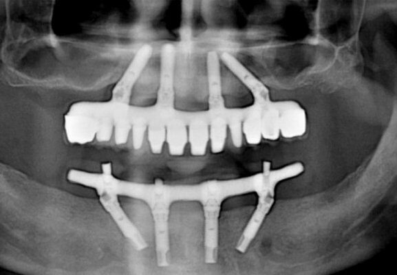 All On 4 Dental Implants - Amelia Perfect Smile
